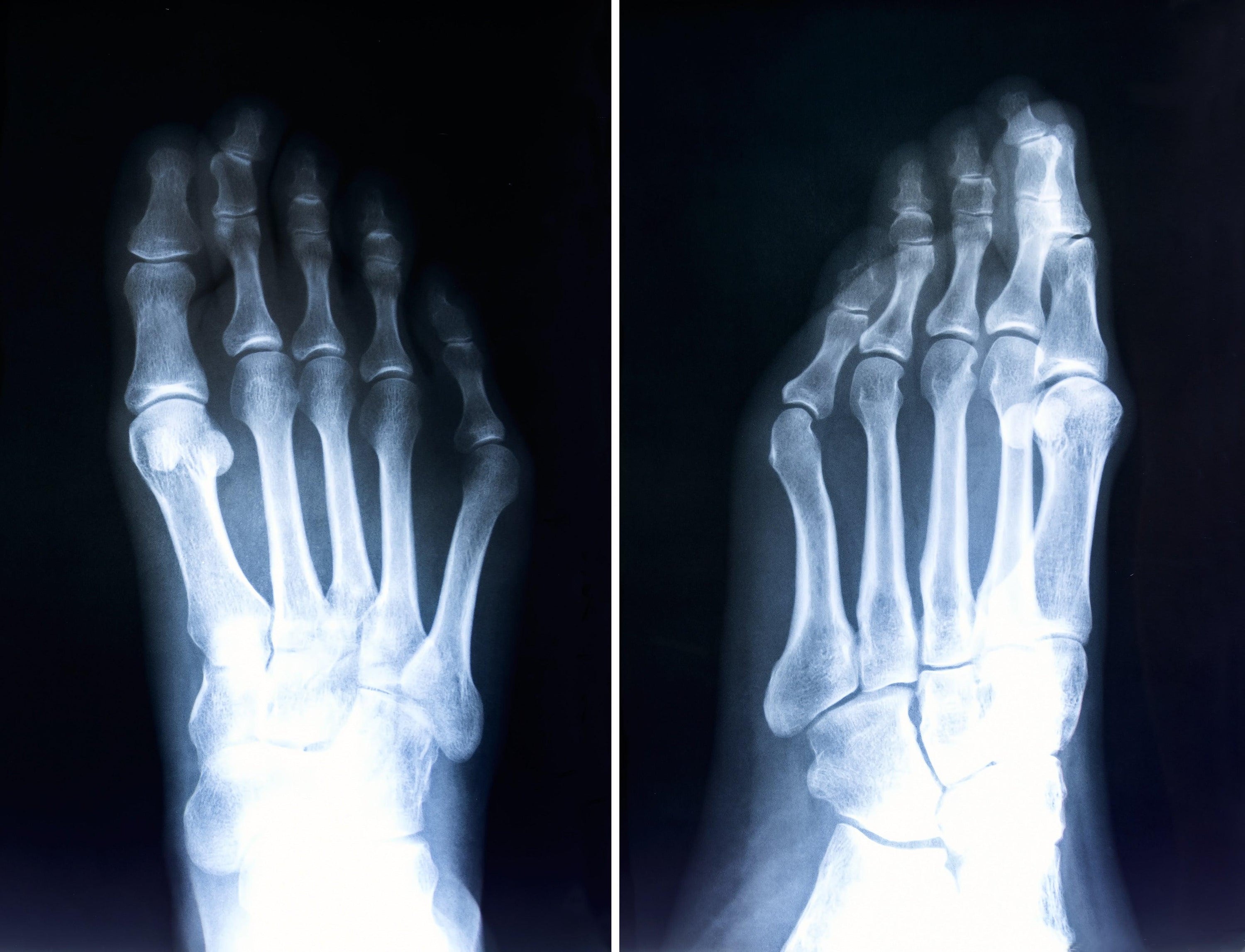 10 Relief Tips for Bunion on Pinky Toe | NatraCure - NatraCure